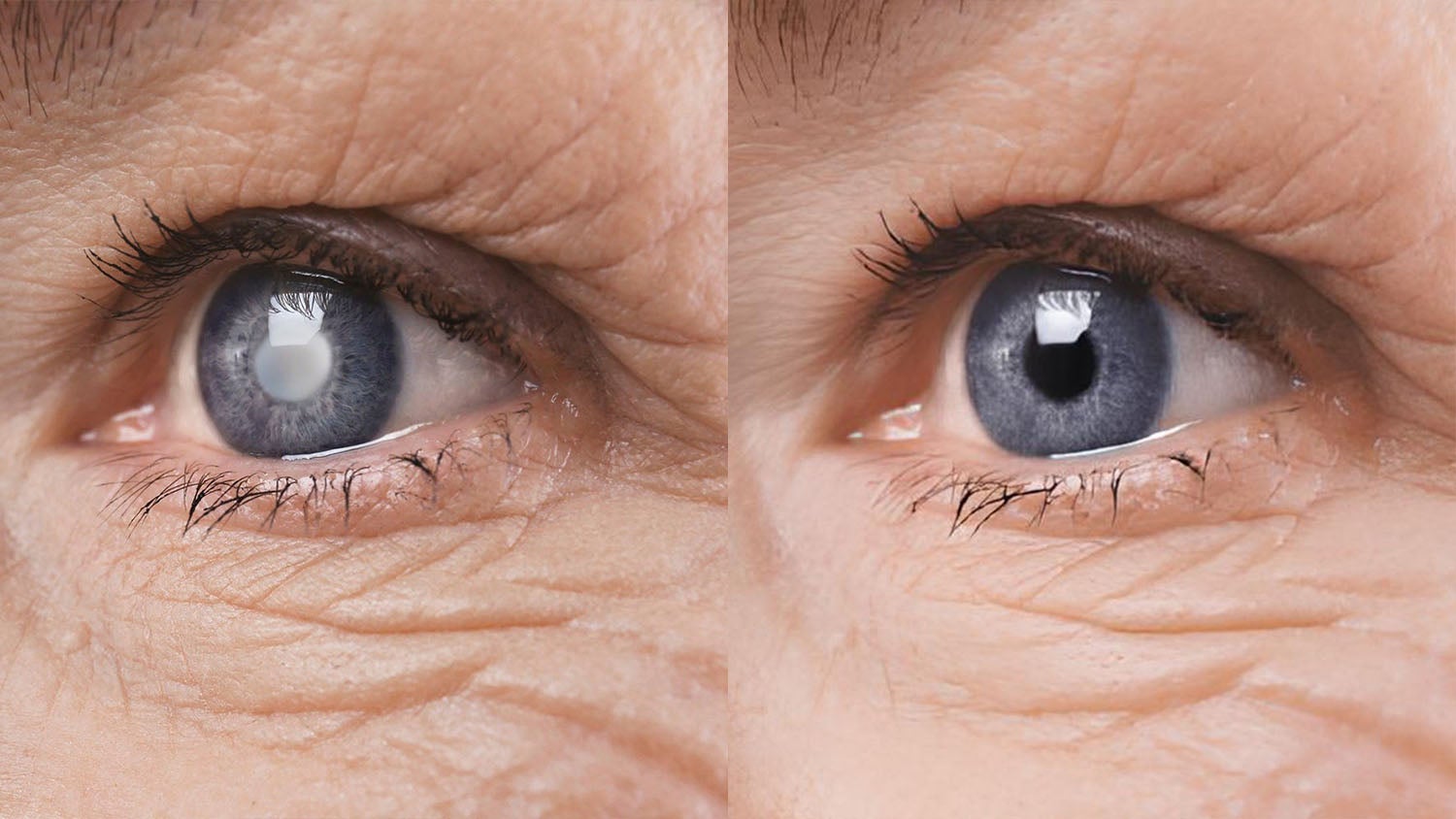 Top Ophthalmologists: This Is The Best Way To Restore 20/20 Vision ...