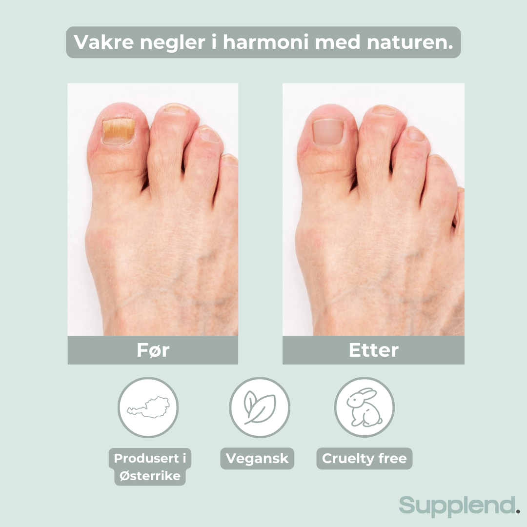 #1 løsning mot neglesopp