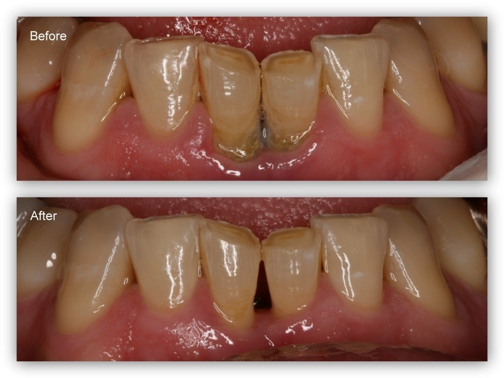Advertorial Teeth Repair Gel