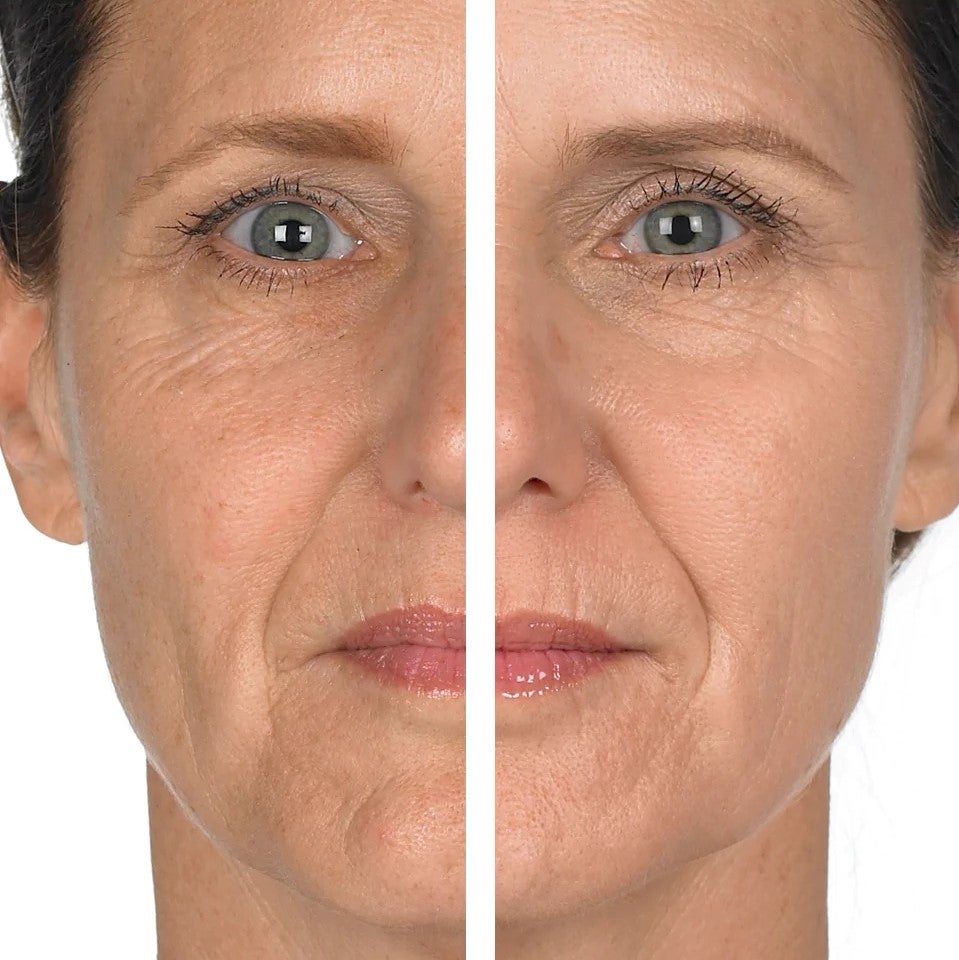 EMS Face-Lift Qartel™