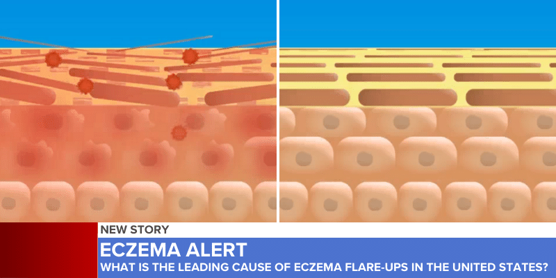 Break Your Eczema Cycle