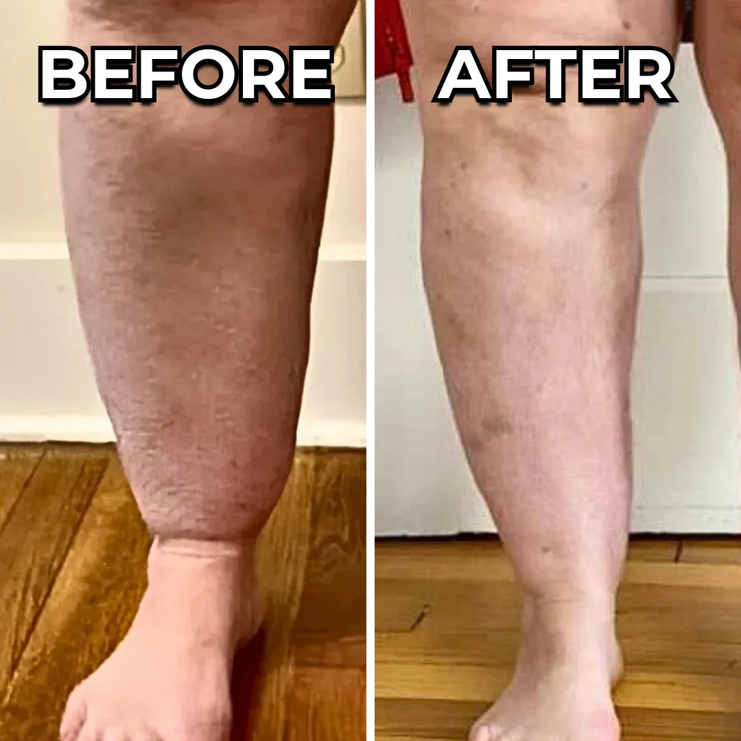Swellfree™ Lipedema Leggings