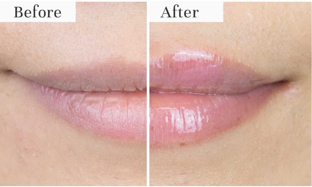Expert Reveal: Why Women Over 50 Are Using This Micro-Infusion System ...